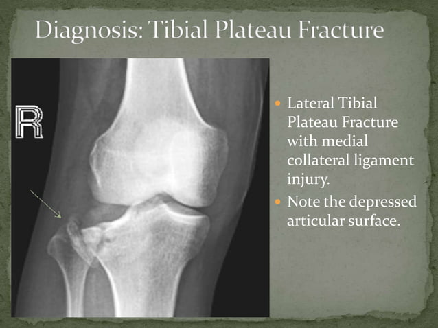 Tibial Plateau Fracture | PPTX | Death, Injury, or Military Conflict ...