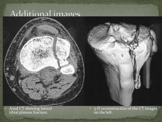 Tibial Plateau Fracture | PPTX