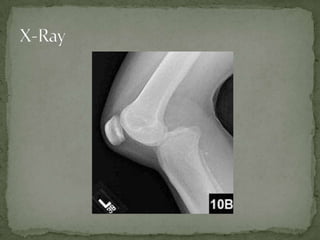 Posterior Knee Dislocation | PPTX