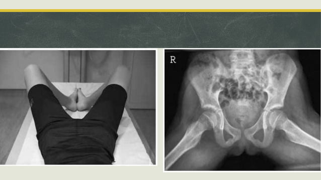 Femur and Hip.ppt positioning of femur & | PPT