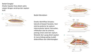 femur Approach posterolsteral approach.pptx