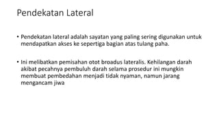 femur Approach posterolsteral approach.pptx