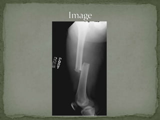 Femoral Shaft Fracture | PPT
