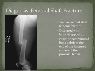 Femoral Shaft Fracture | PPT