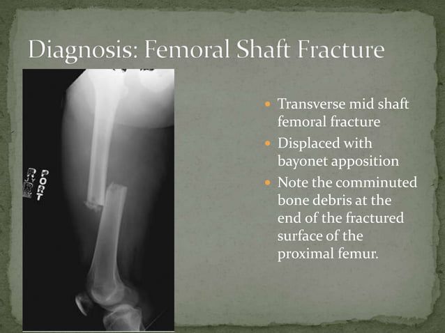 Femoral Shaft Fracture | PPT