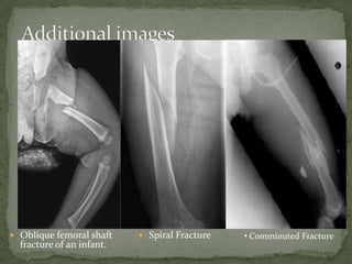 Femoral Shaft Fracture | PPTX
