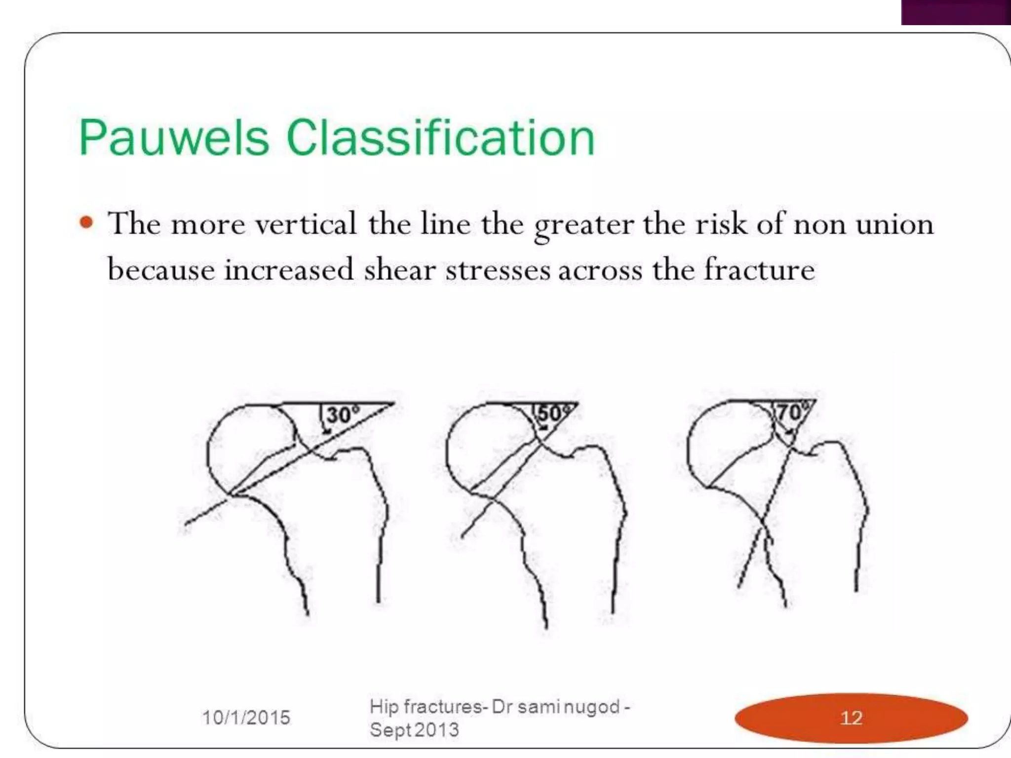 Femur fracture | PPTX