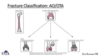 Femur Fracture power point gagahagwhagahahaha | PDF