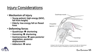 Femur Fracture power point gagahagwhagahahaha | PDF