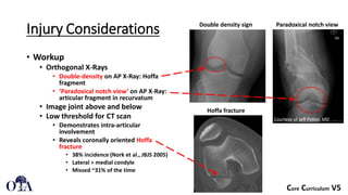 Femur Fracture power point gagahagwhagahahaha | PDF
