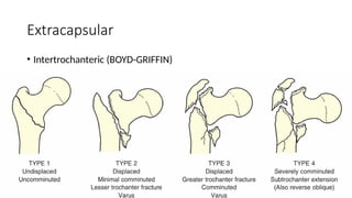 FEMUR FRACTURES- Head and Neck and classification | PPTX