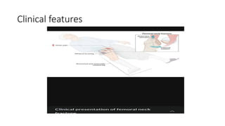 FEMUR FRACTURES- Head and Neck and classification | PPTX