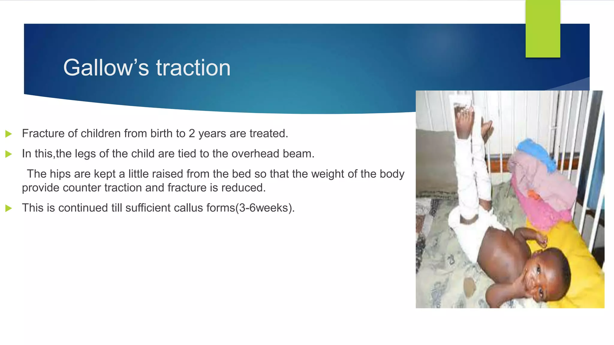fracture of shaft of femur | PPTX