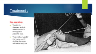 fracture of shaft of femur | PPTX