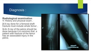 fracture of shaft of femur | PPTX