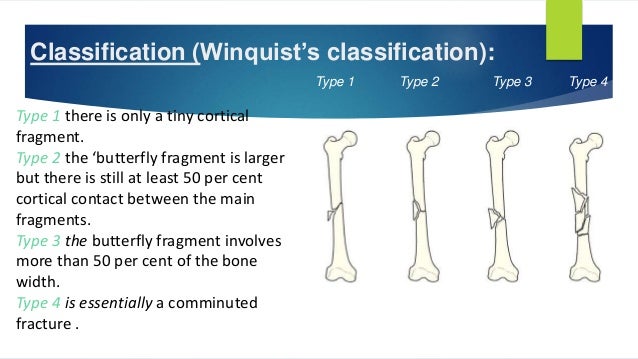 fracture of shaft of femur