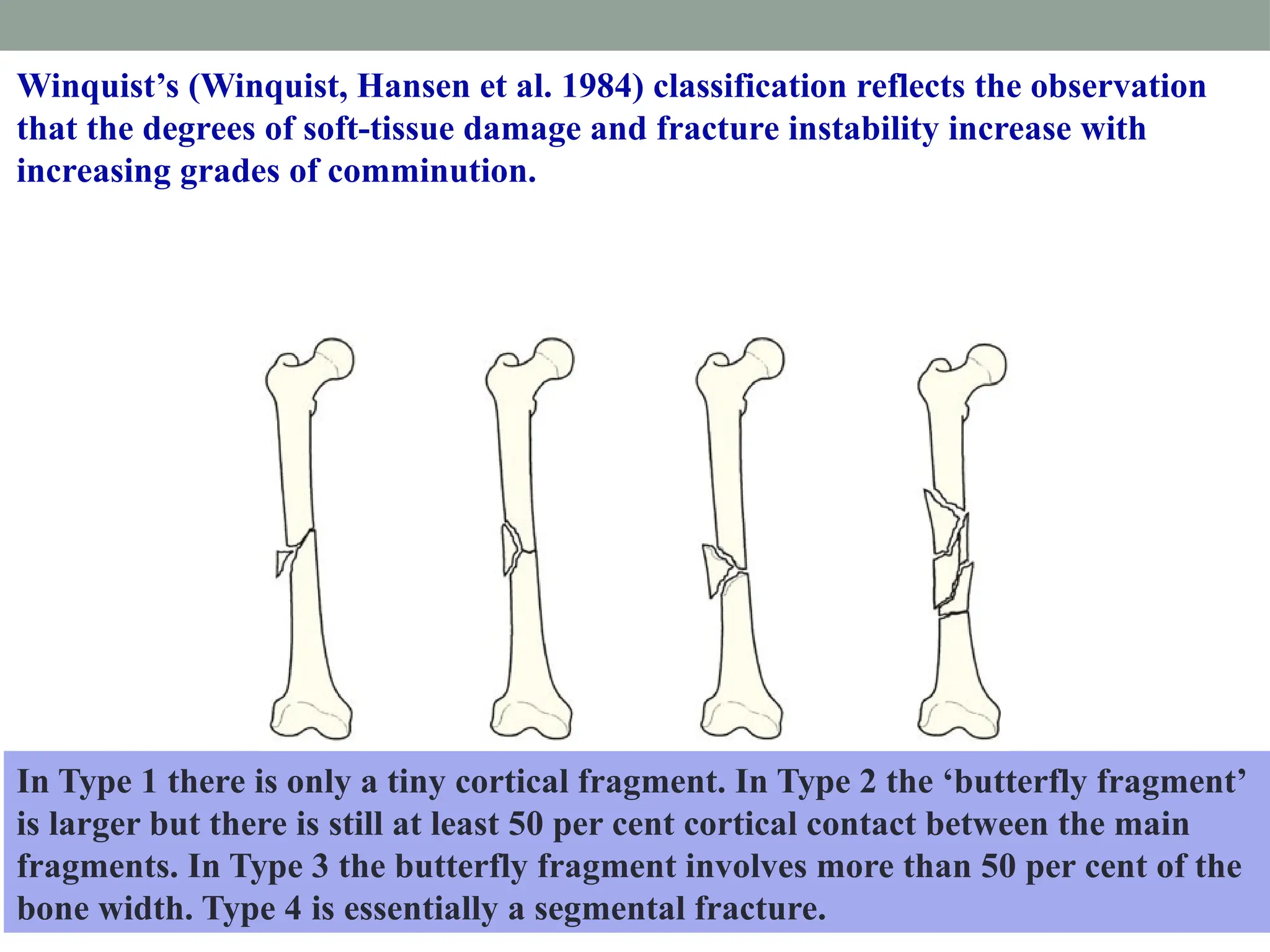 Principeles of femur shaft fracture.pptx