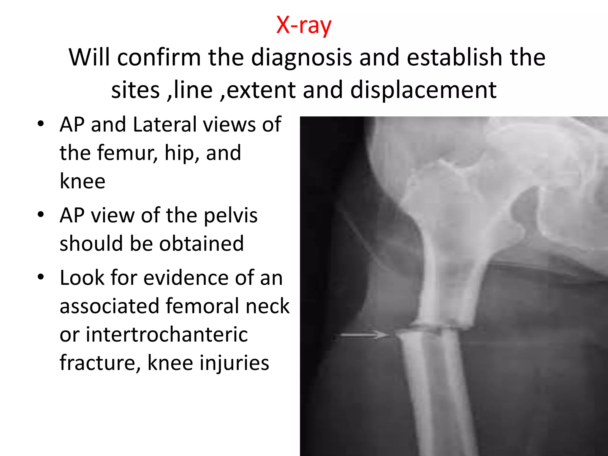 Femur shaft fractures | PPTX