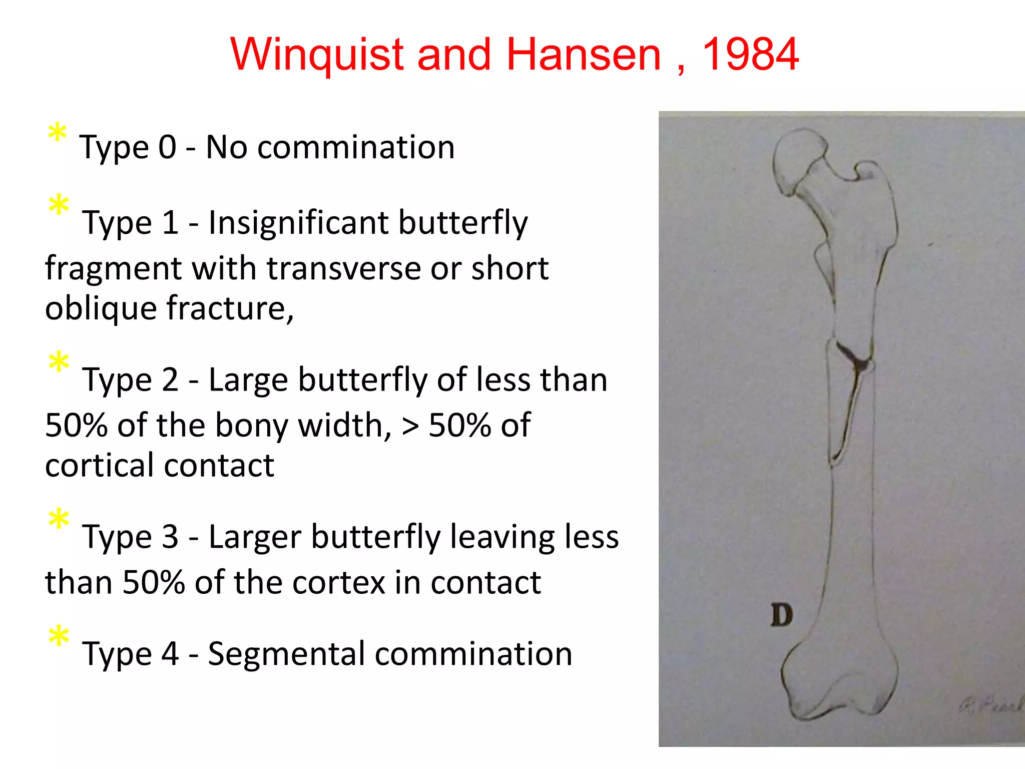 Femur shaft fractures | PPTX