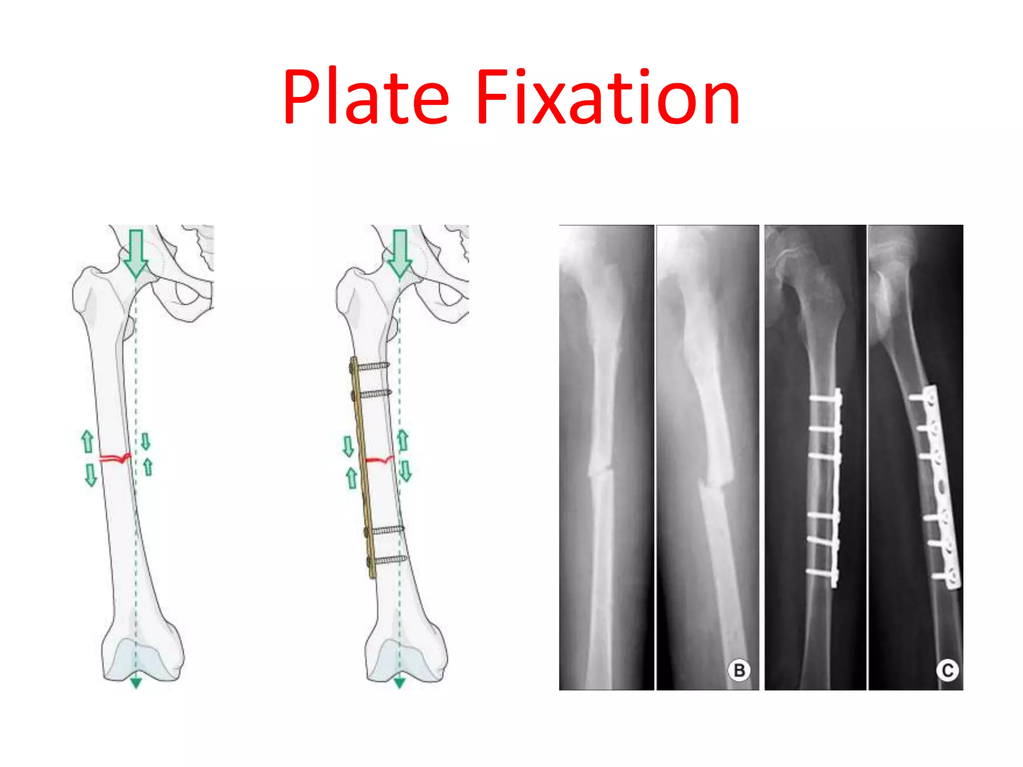 Femur shaft fractures | PPTX