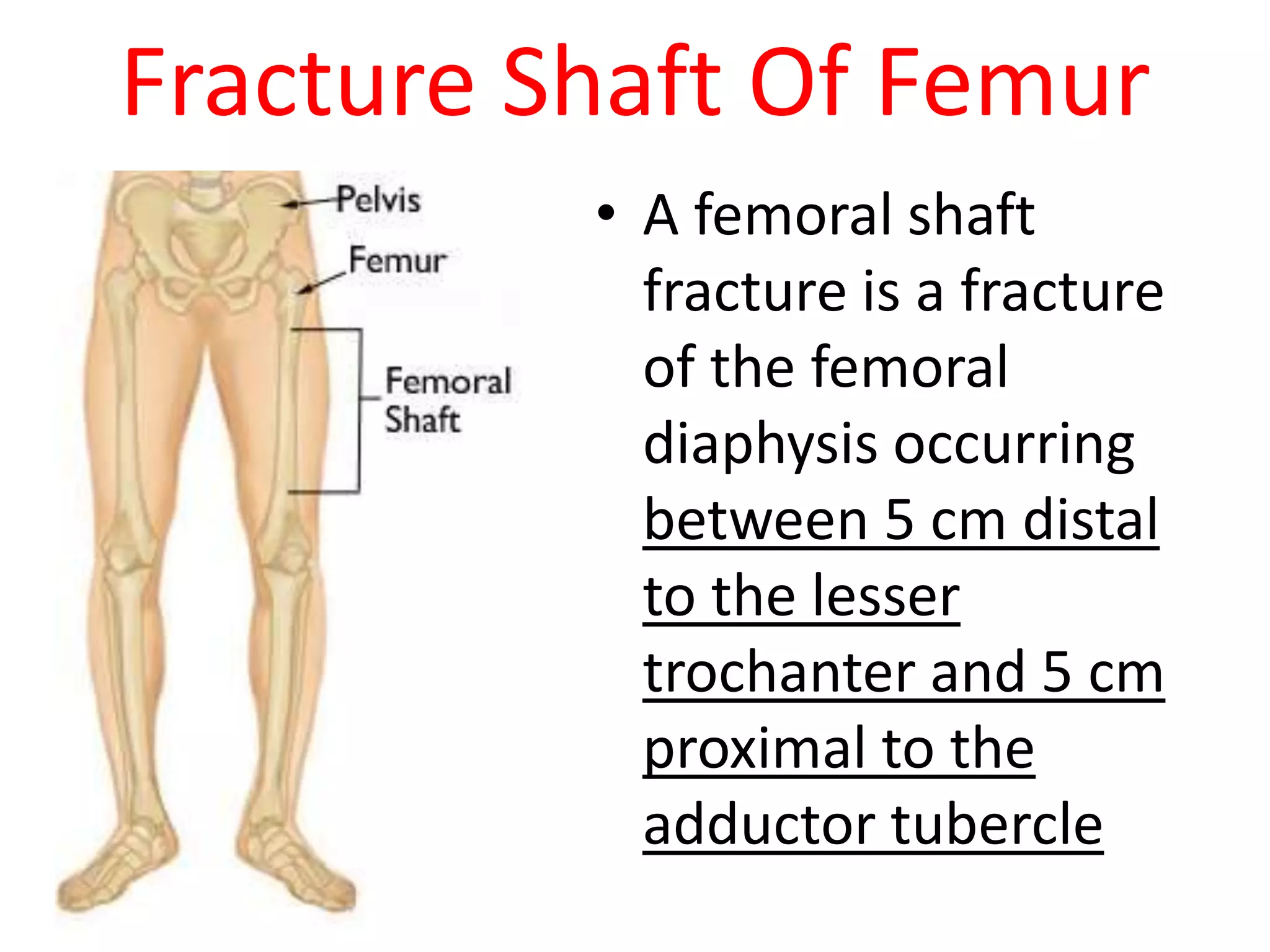 Femur shaft fractures | PPTX