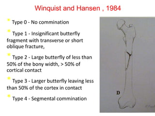 Femur shaft fractures | PPTX