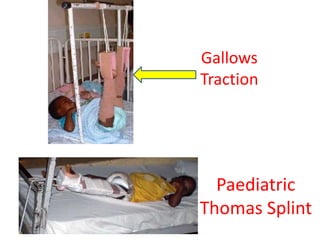 Femur shaft fractures | PPTX | Death, Injury, or Military Conflict ...