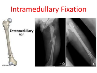 Femur shaft fractures | PPTX