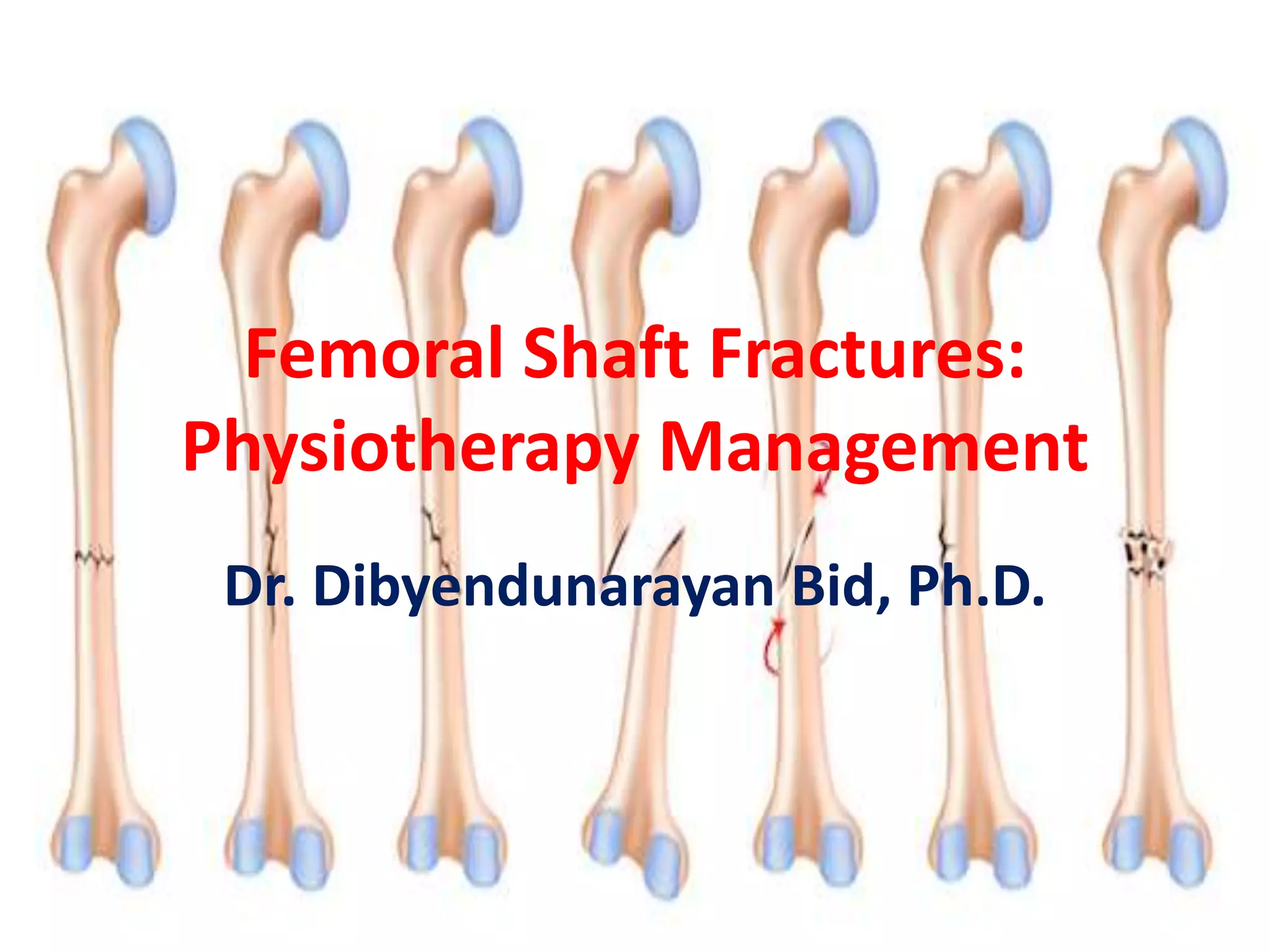 Femur shaft fractures Physiotherapy | PPTX