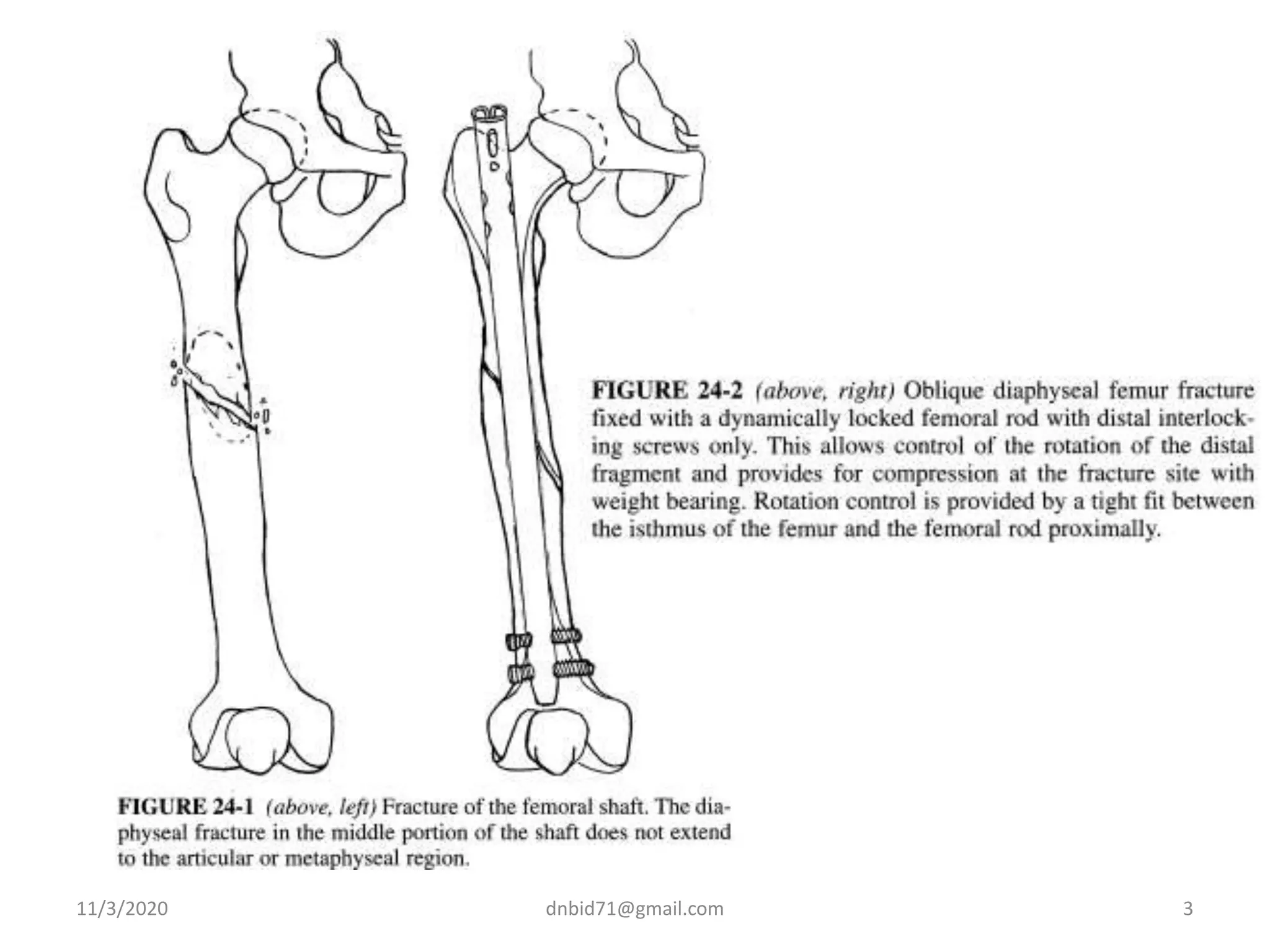 Femur shaft fractures Physiotherapy | PPTX