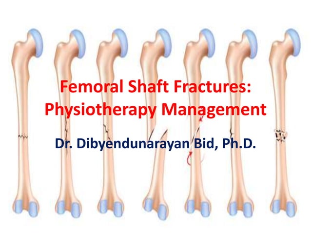 Femur shaft fractures Physiotherapy | PPTX