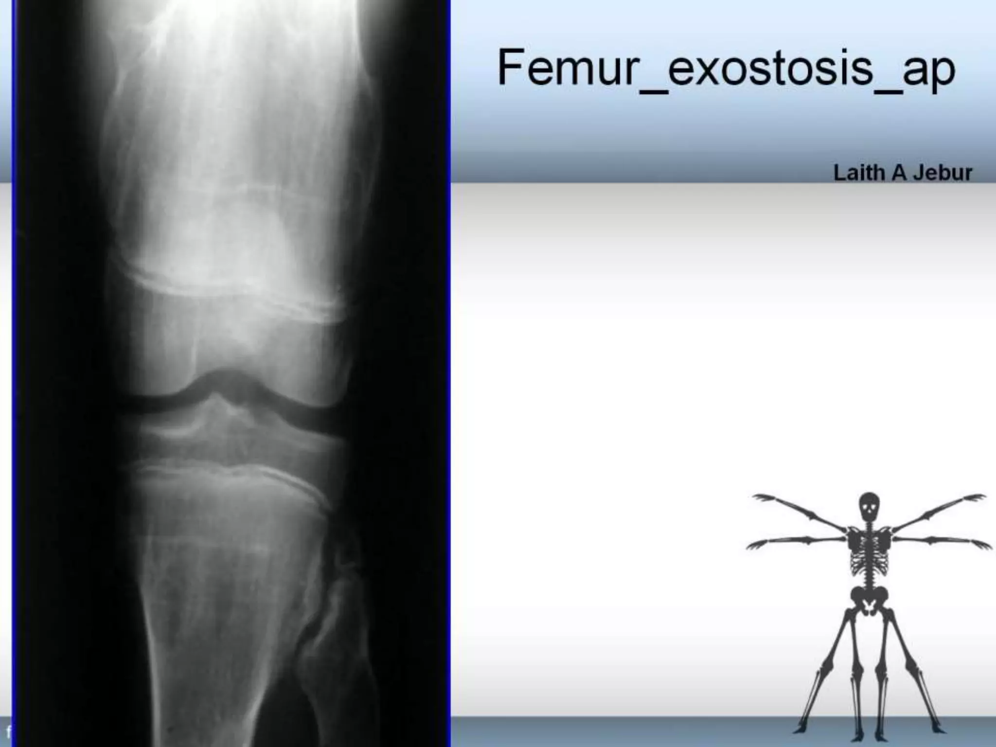 Femur x rays | PPSX