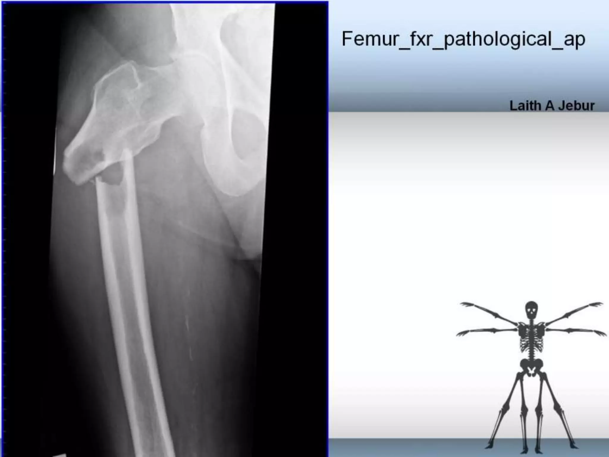 Femur x rays | PPSX