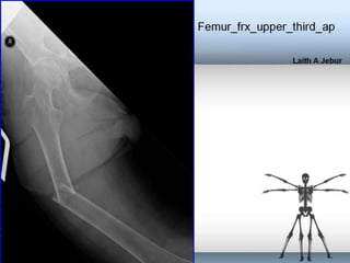 Femur x rays | PPSX