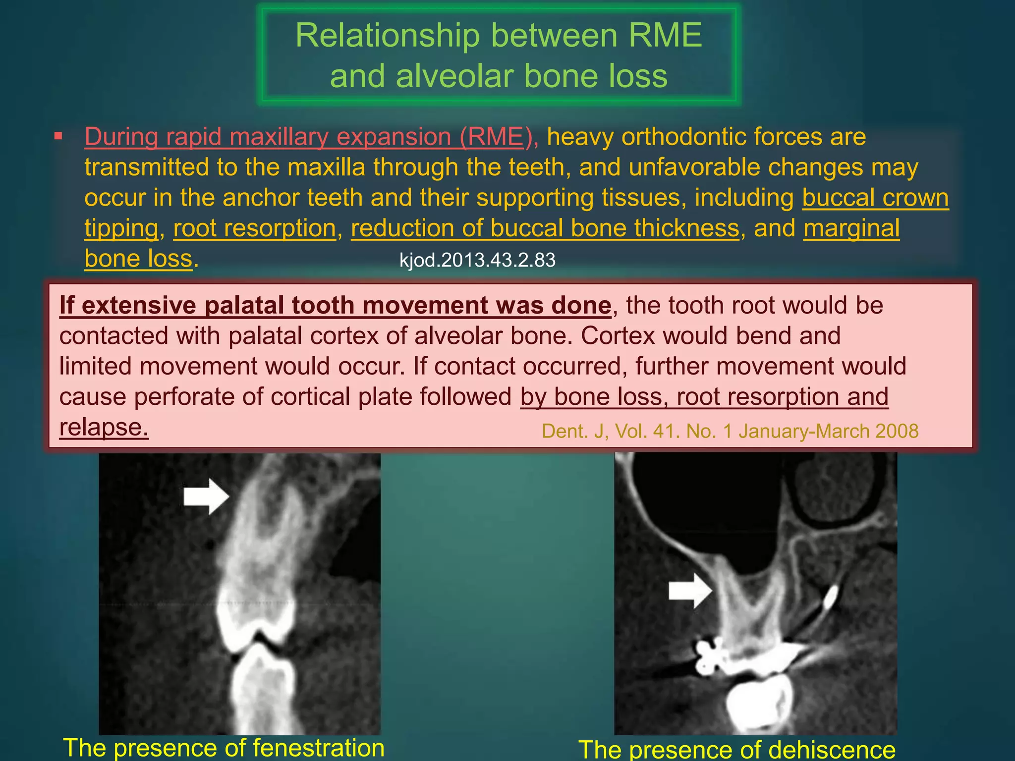 Fenestration and dehiscence | PPTX