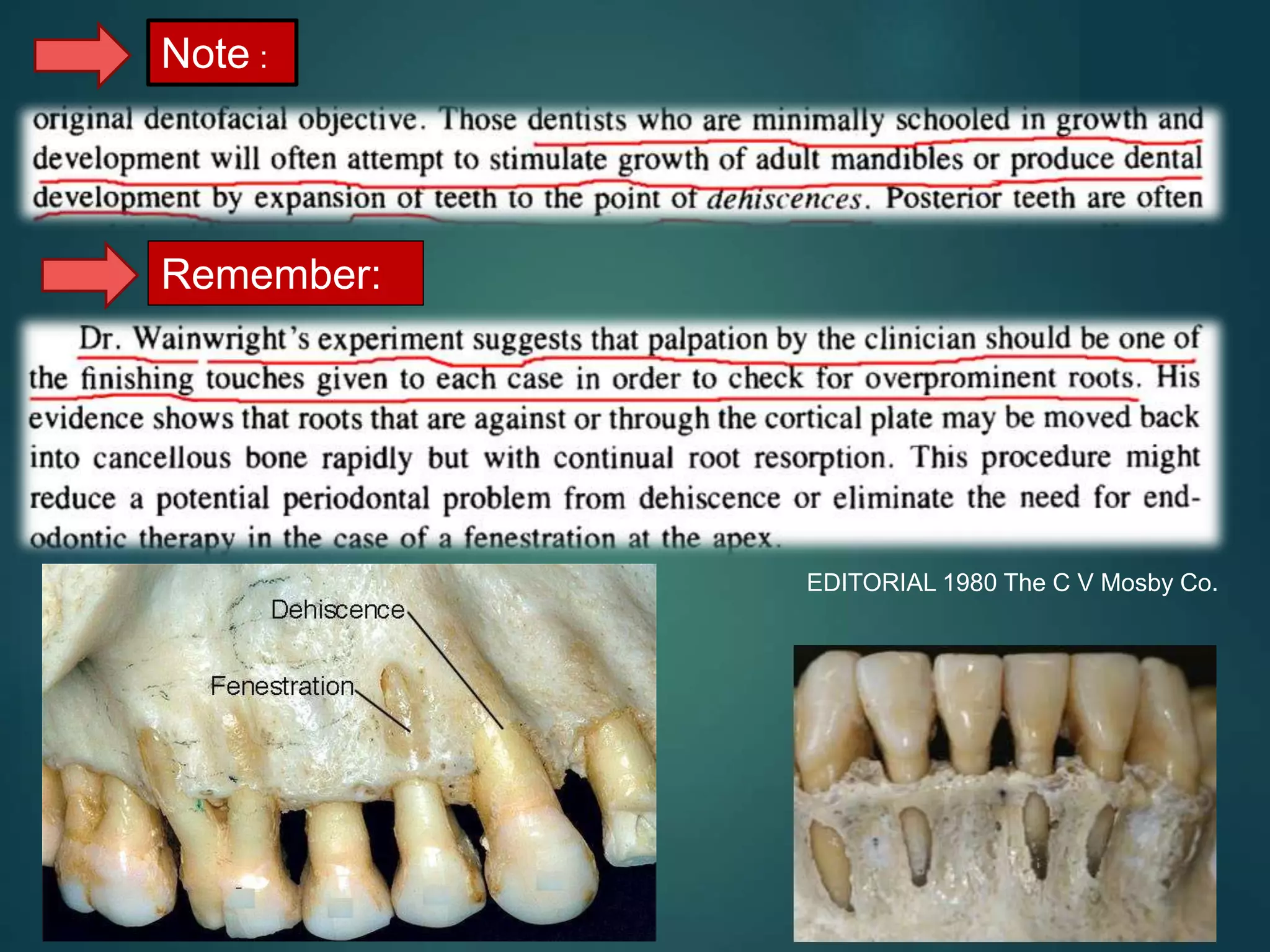 Fenestration and dehiscence | PPTX