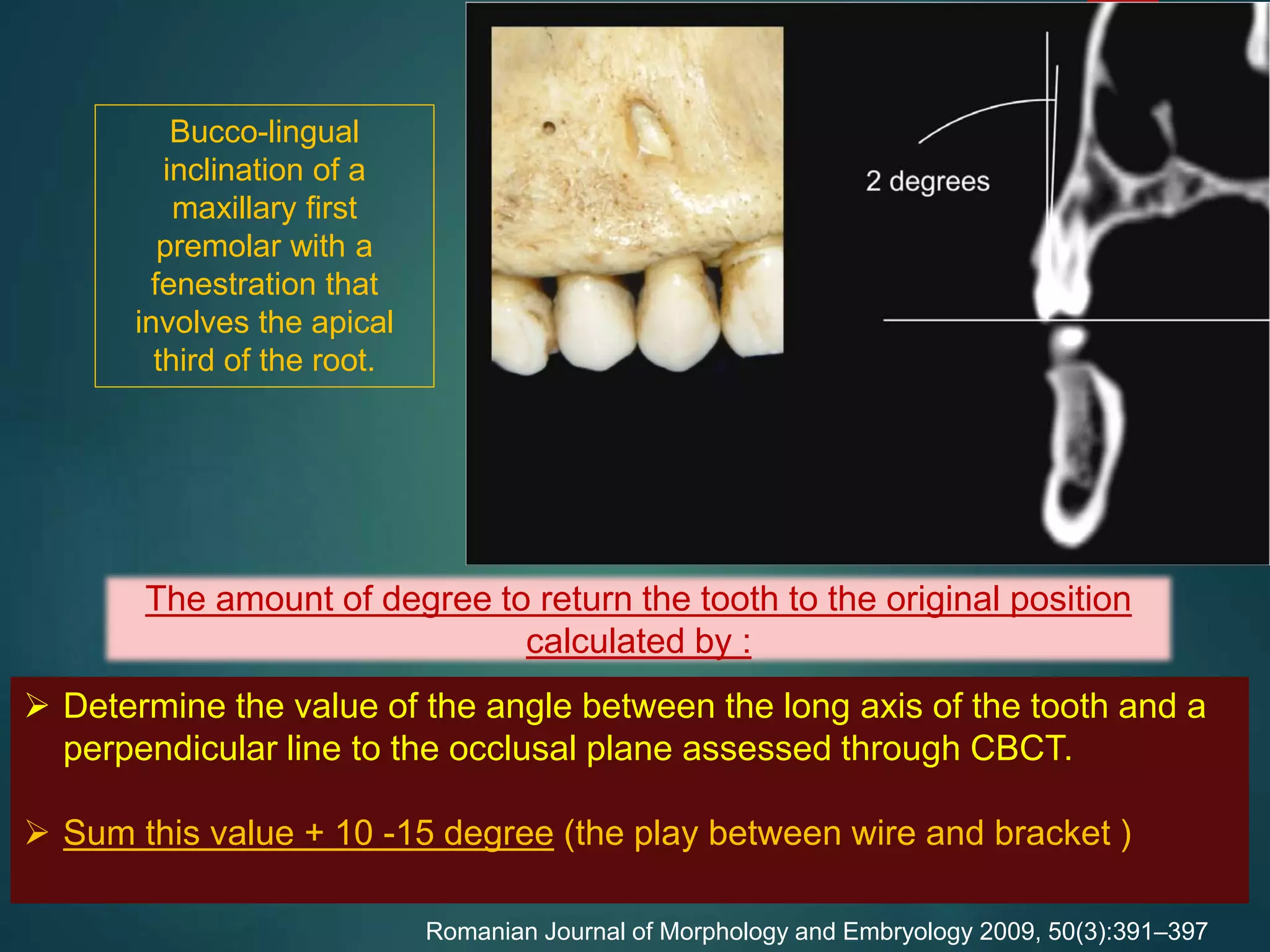 Fenestration and dehiscence | PPTX