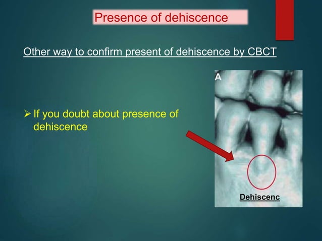 Fenestration and dehiscence | PPTX | Dental Health | Diseases and ...