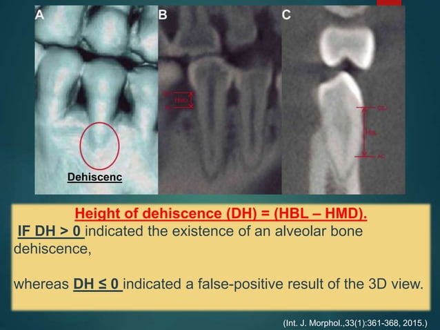 Fenestration and dehiscence | PPTX | Dental Health | Diseases and ...