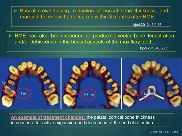 Fenestration and dehiscence | PPTX | Dental Health | Diseases and ...
