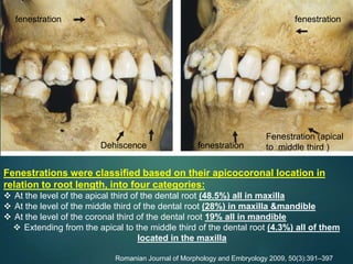 Fenestration and dehiscence | PPTX