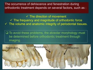 Fenestration and dehiscence | PPTX