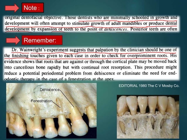 Fenestration and dehiscence