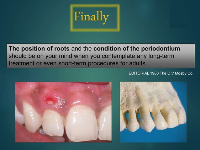 Fenestration and dehiscence