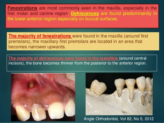 Fenestration and dehiscence