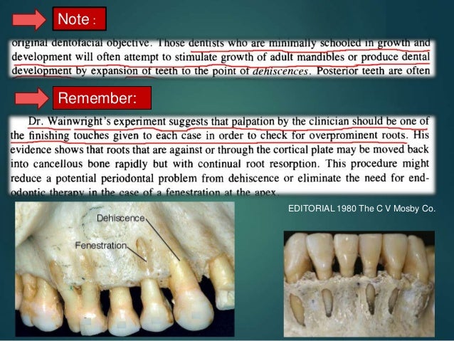 Fenestration and dehiscence