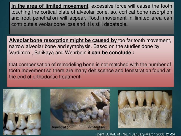 Fenestration and dehiscence
