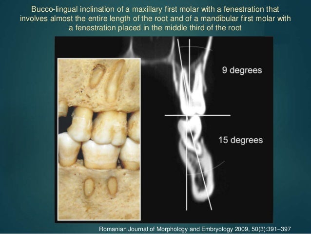 Fenestration and dehiscence
