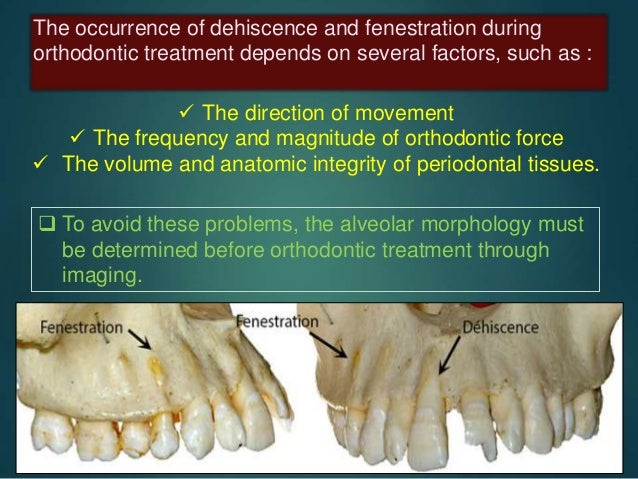 Fenestration and dehiscence
