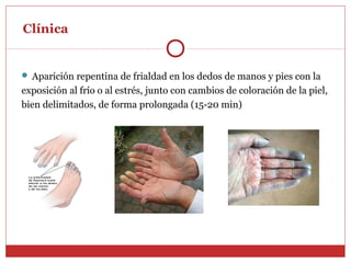 Fenómeno de raynaud | PPT